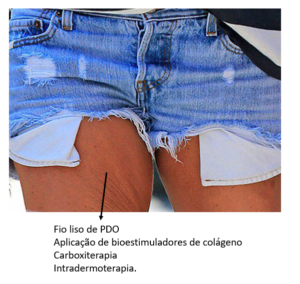 FLACIDEZ NAS COXAS - CLÍNICA BELLA PELLE